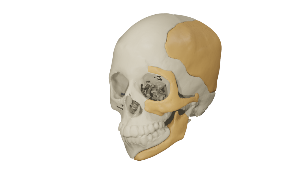 Patient-Specific Implants - ProtoMed Singapore Pte Ltd